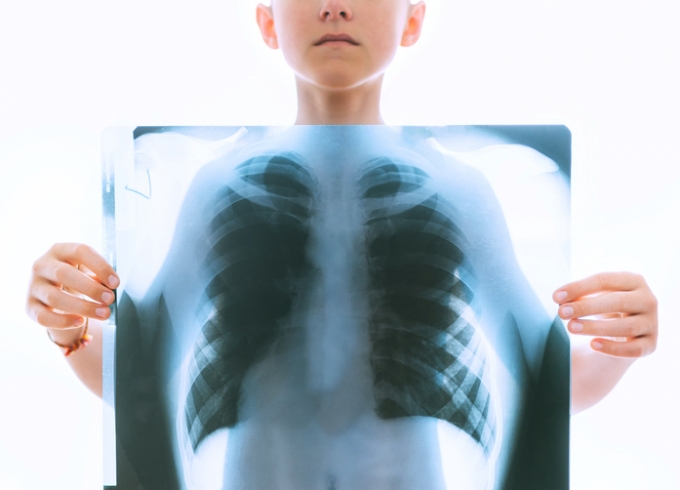 Understanding Tuberculosis in Infants and Young Children: Symptoms ...