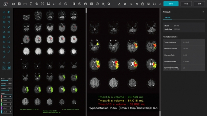 제이엘케이, 뇌관류 MR 영상 분석 솔루션 'JLK-PWI' FDA 인허가 신청 - 머니투데이