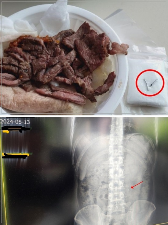 "투뿔한우 먹다가 주삿바늘 삼켜"…엑스레이에 그대로 찍혔다 - 머니투데이